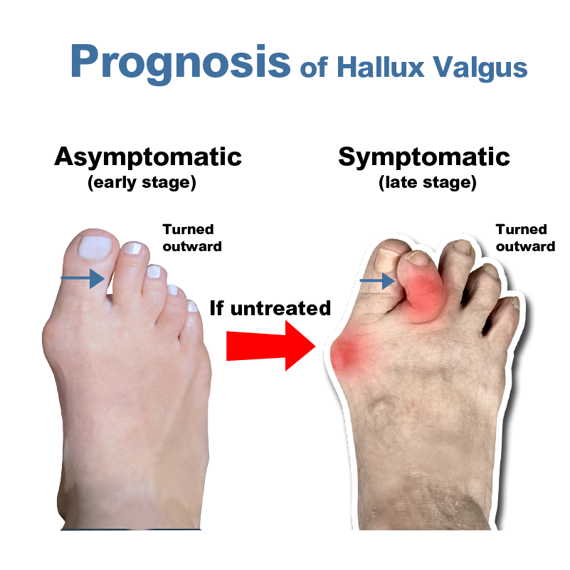Medex. Hallus Valgus, Hammer toe, overlapping toe, Tailor’s bunion ...